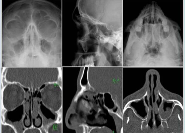 tac-com-menos-radiacao-para-diagnosticar-sinusite | Luz Saúde